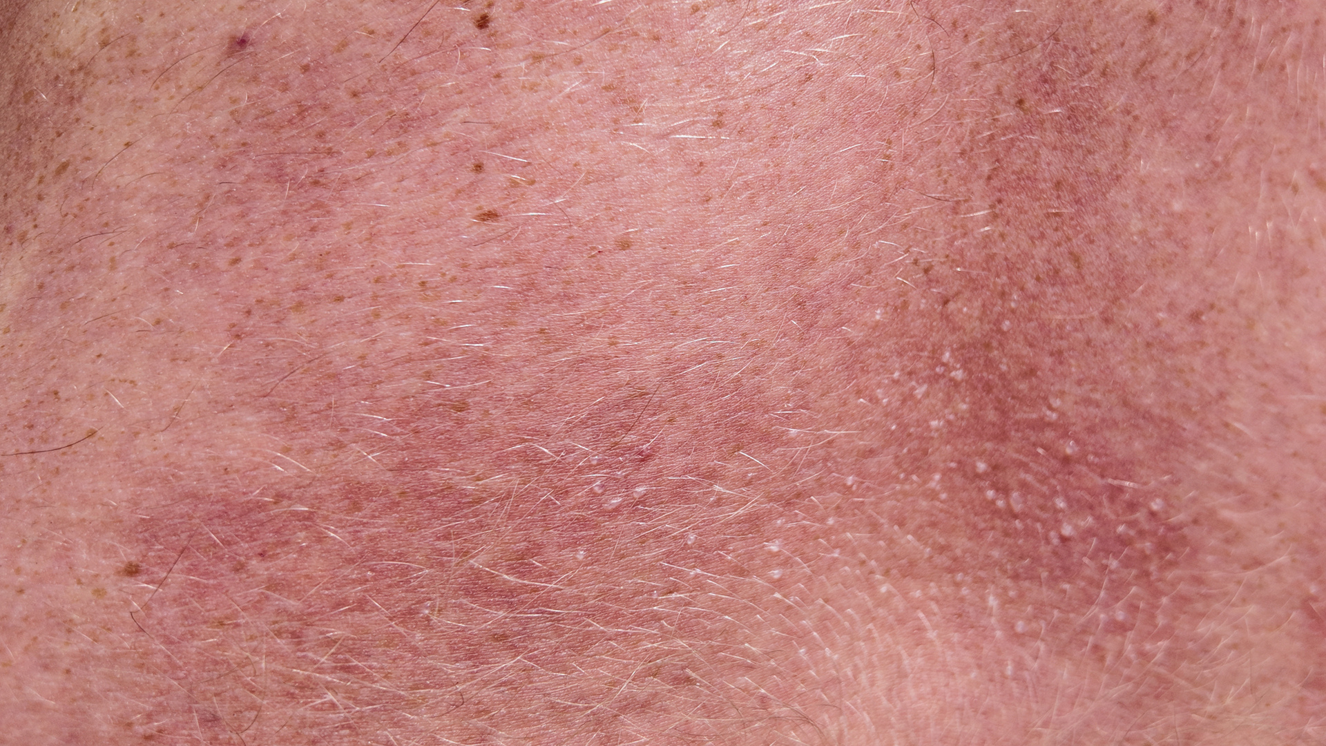 How to Tell If Your Skin Barrier Is Damaged—And Repair It Fast - Truth ...